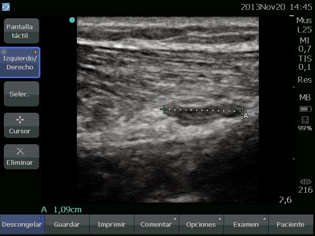 DR GALÁN - LESIONES DEPORTIVAS: ROTURA MUSCULAR GRADO II DEL MÚSCULO ...
